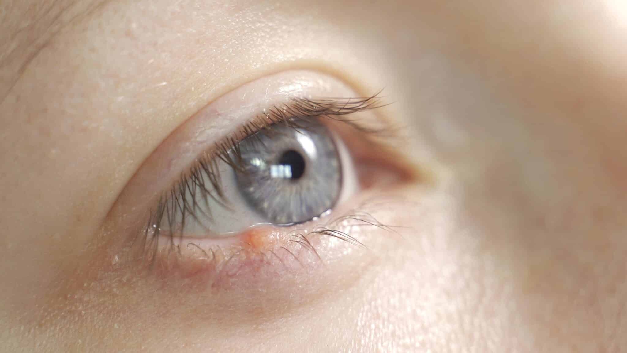 Gerstenkorn – Ursachen und Symptome – Augenarzt Dr. med. Helmut ...